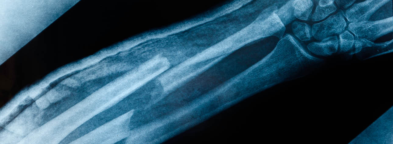 Fracture Care Experts | PCI Orthopedics | Cedar Rapids